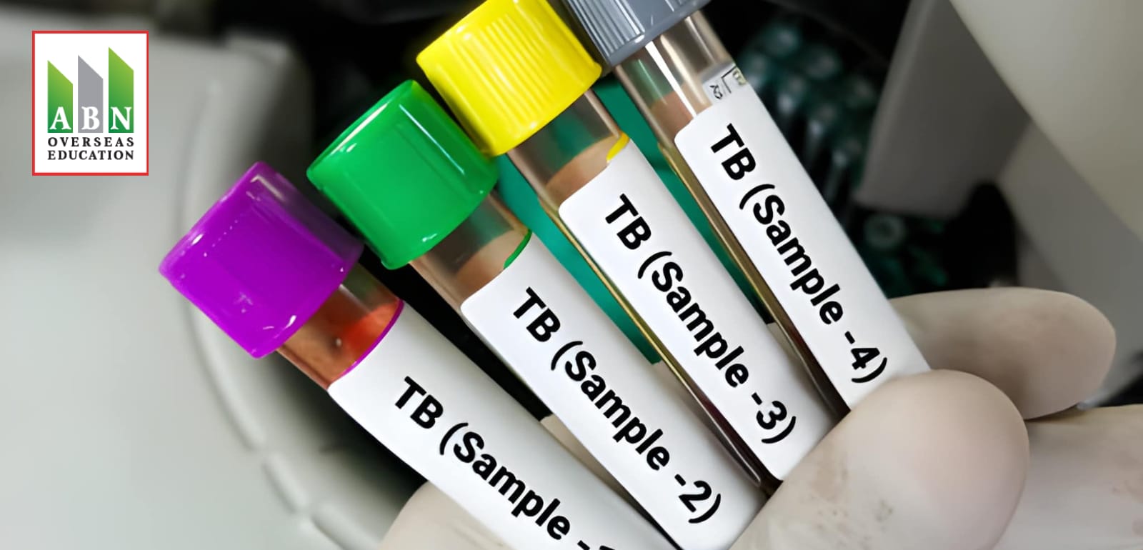 Why TB Test Is Required for UK Visa – Abneducation